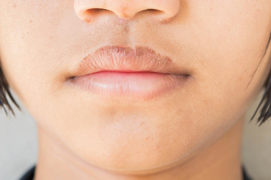 Health Tips: What does it mean when lips get dry, cracked, and dark ...