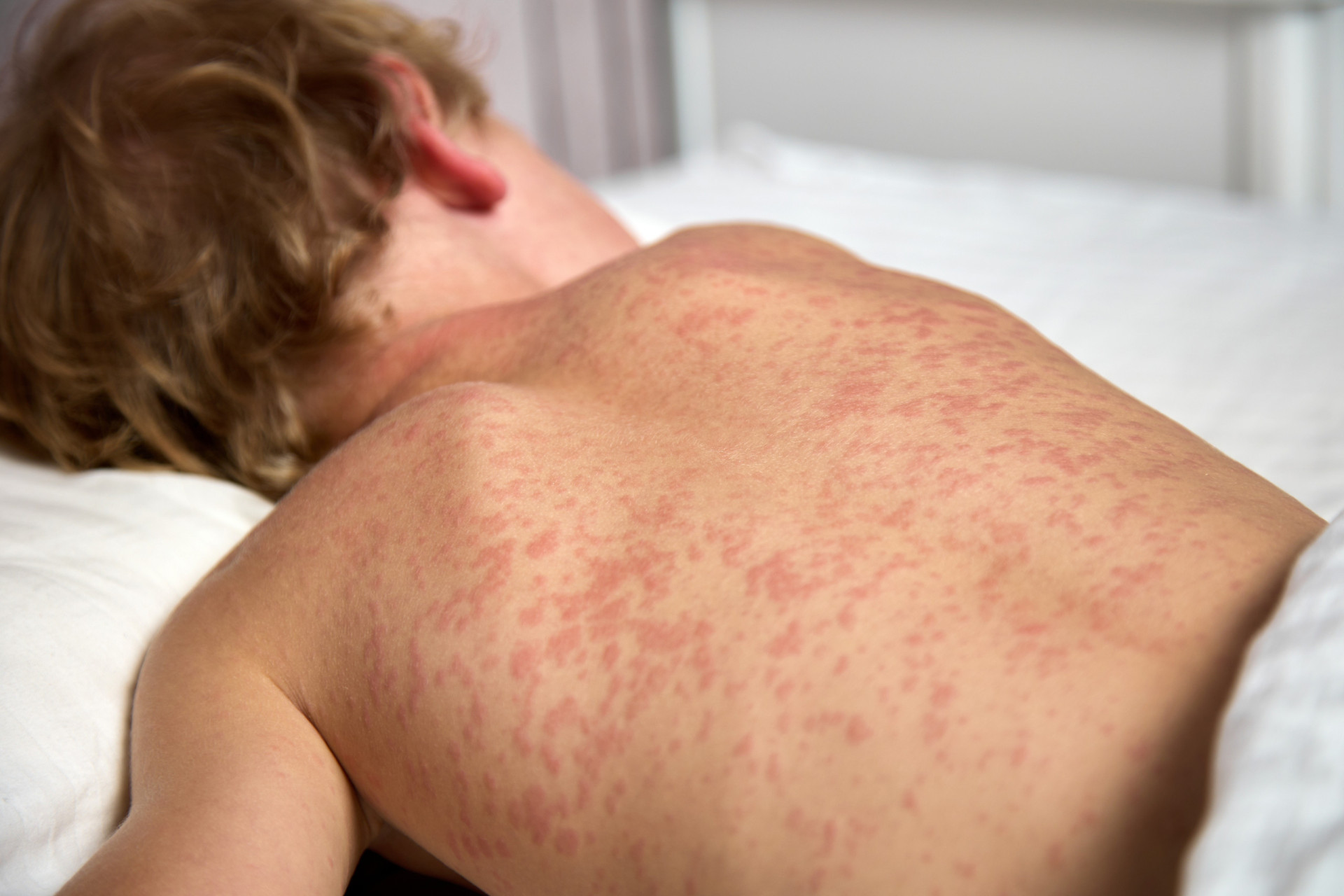 How dangerous is measles?