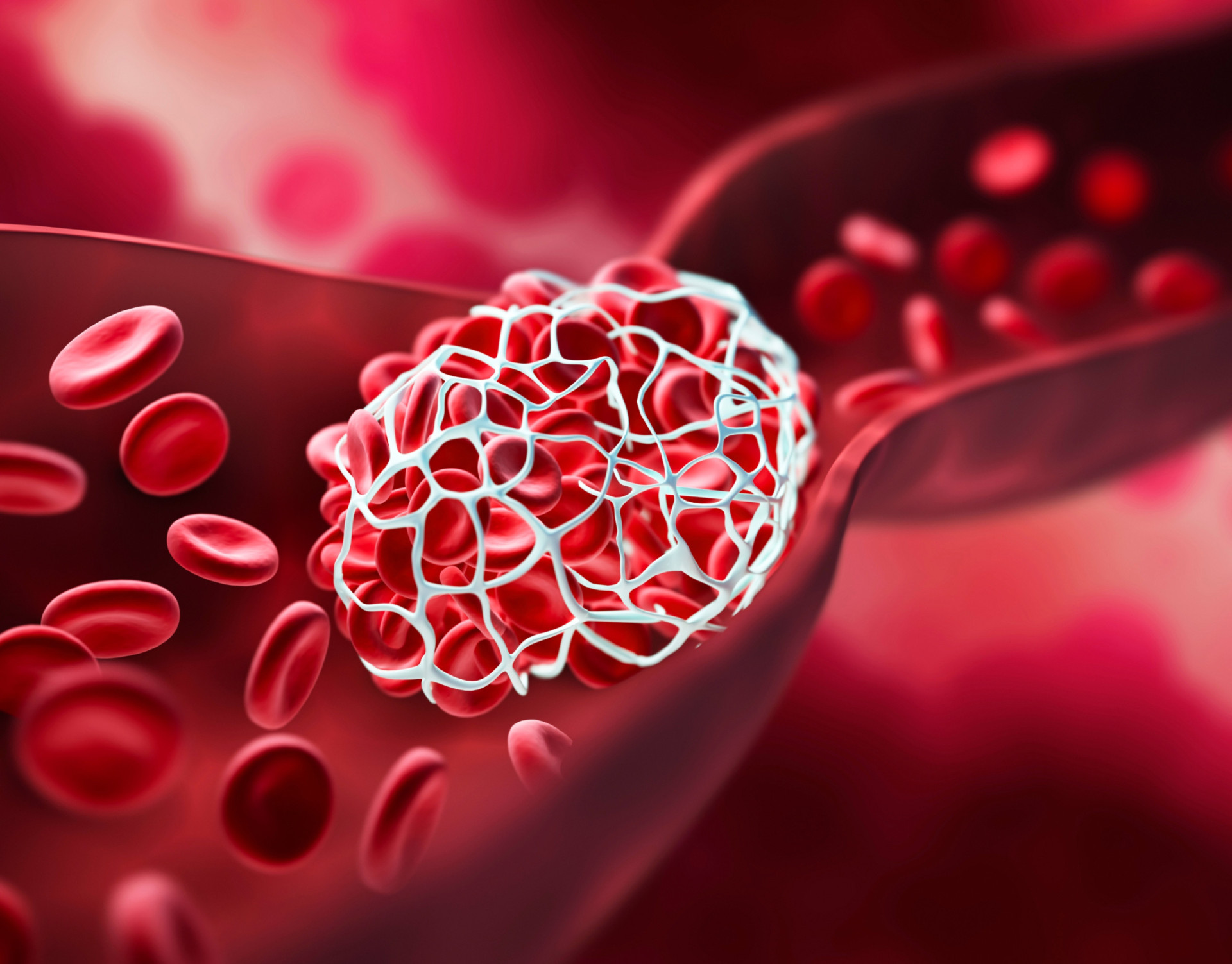 What exactly is Hughes syndrome?