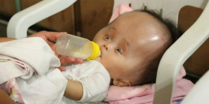 Hydrocephalus: Causes, Symptoms, and How to Treat It