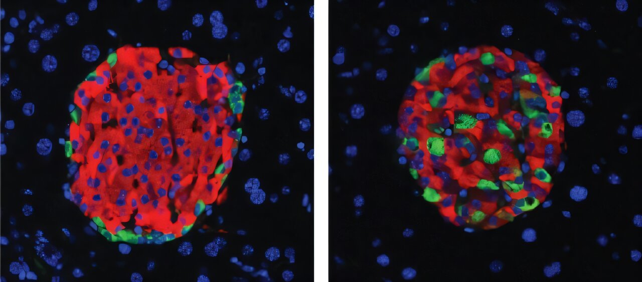 Neonatal diabetes model provides insights on how condition develops