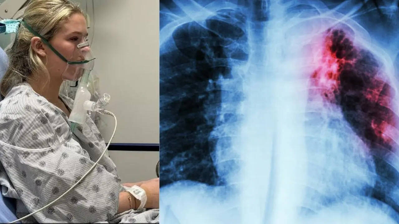 Popcorn Lung: Teenager Struggles To Breathe After Developing Rare ...