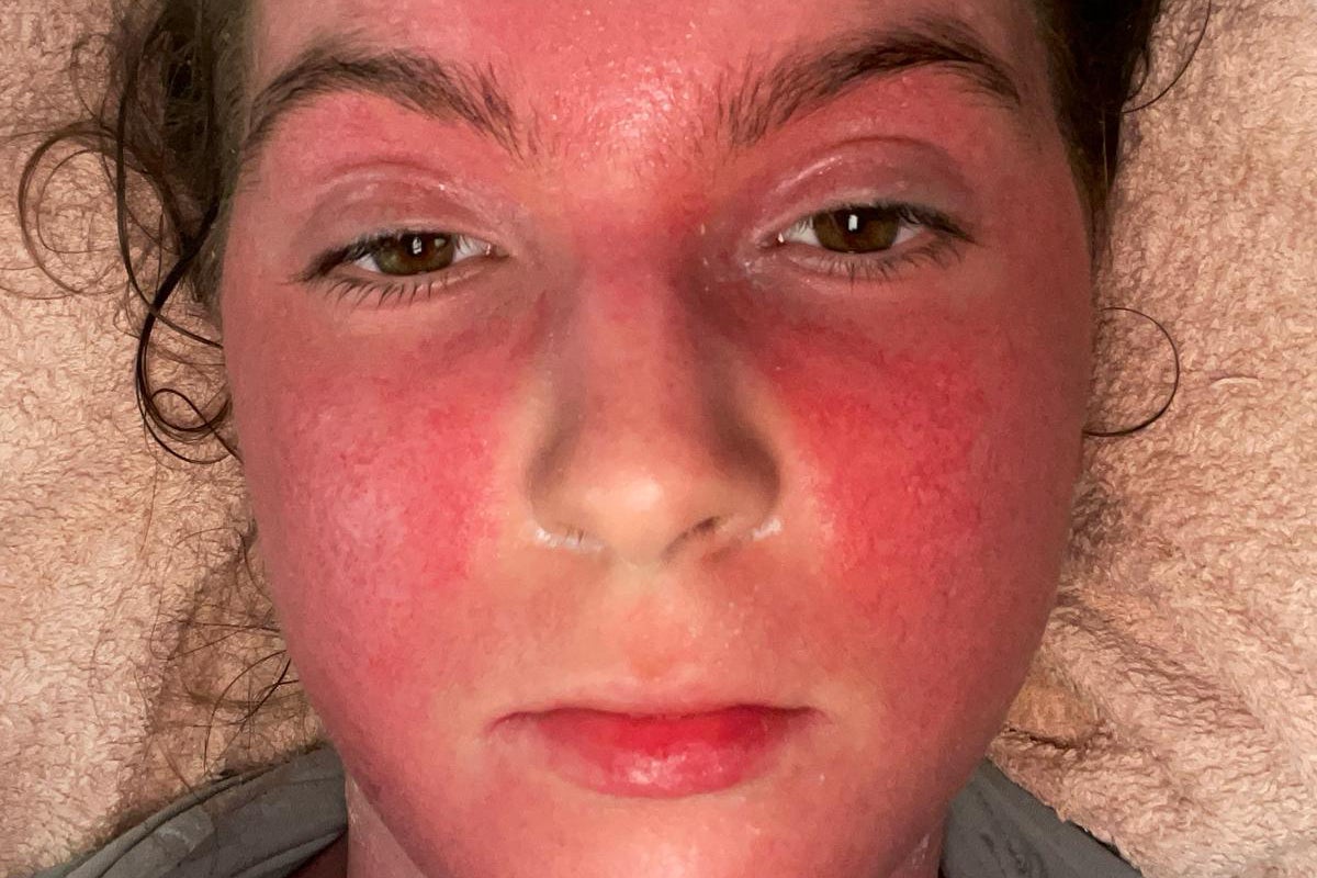 Young woman would ‘do anything’ to have eczema again after extreme reaction