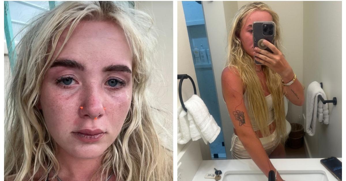 Influencer Kayla Malecc Alleges That Her Ex-Boyfriend Broke Her Jaw ...