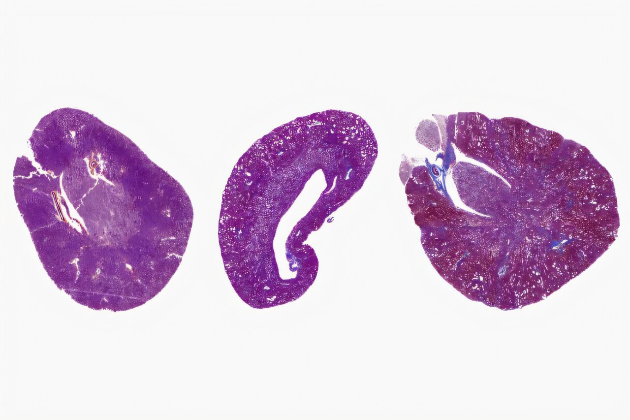 Precision medicine approach targets kidney scarring to prevent failure