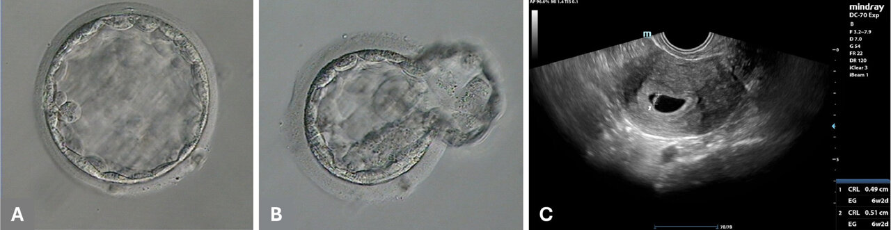 First baby born via fully automated ICSI system