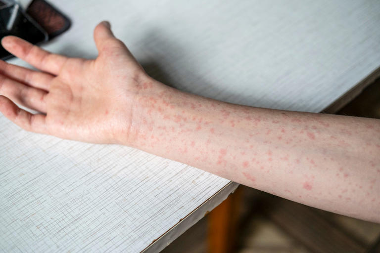 Virginia Health Officials confirm third measles case in Charlottesville