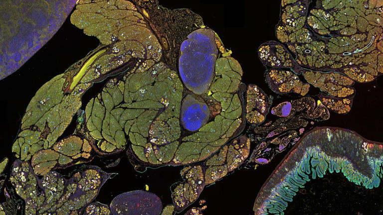 NY lab discovers pancreatic cancer breakthrough that can ‘intercept’ spread