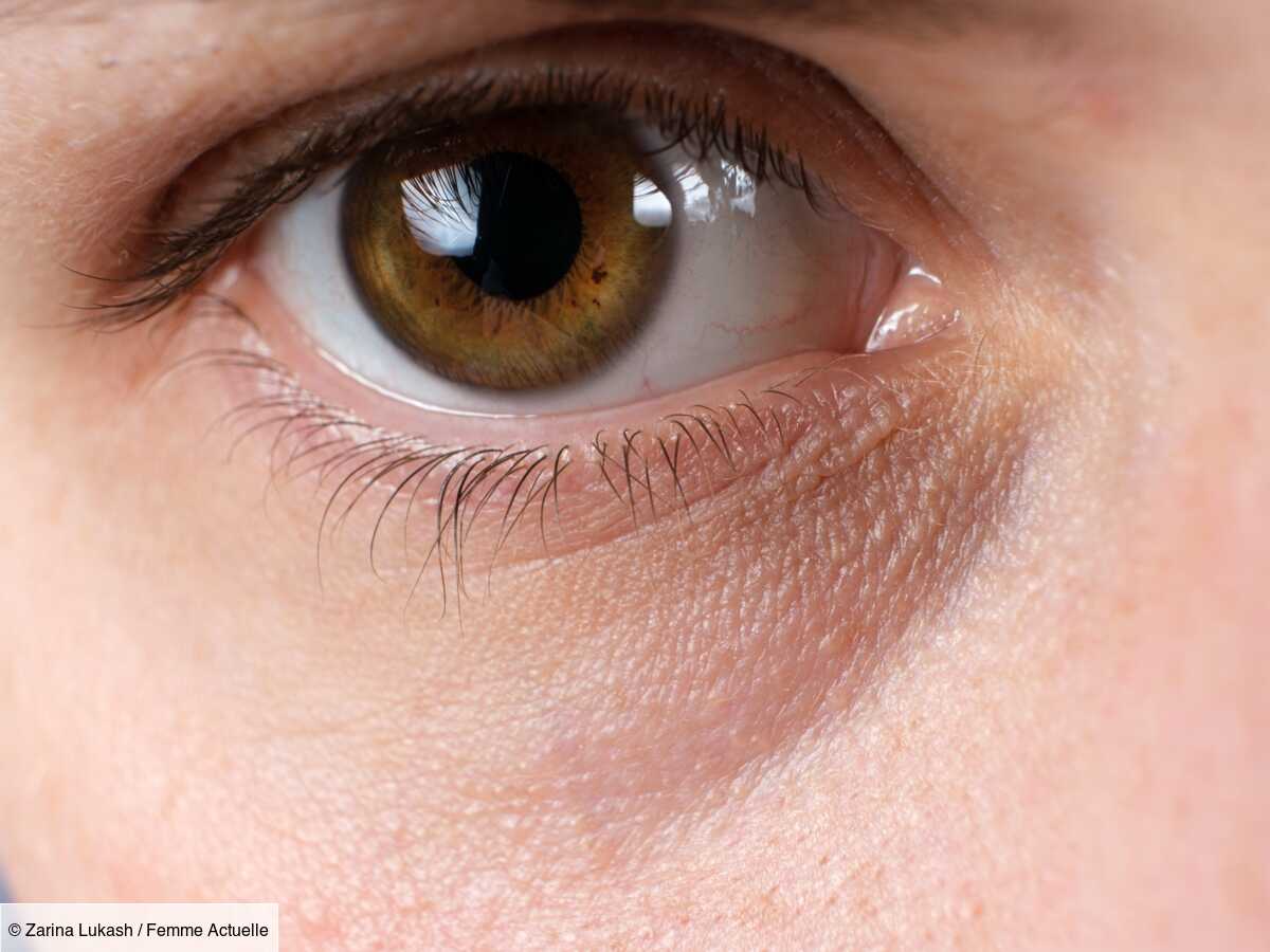 Vous avez des cernes marqués ? Voici l'astuce surprenante d'un ...