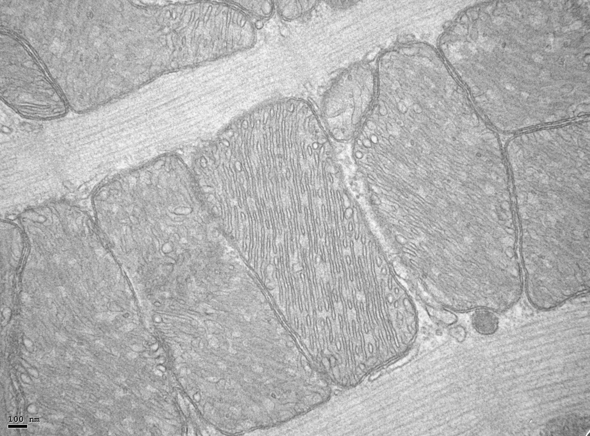 What is POLG mitochondrial disease, the condition that drains the body ...