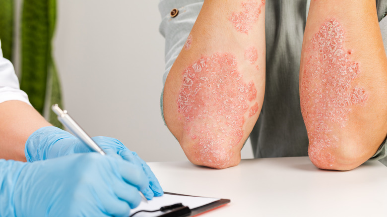 The 5 Types Of Psoriatic Arthritis