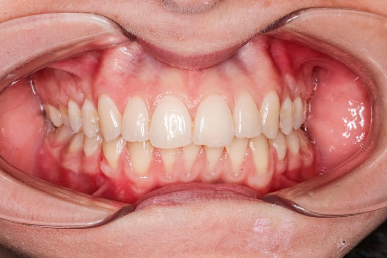 Human teeth could be created in labs in 'dentistry breakthrough'