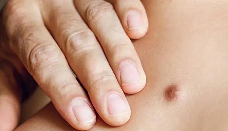 9 Effective Home Remedies To Treat Boils