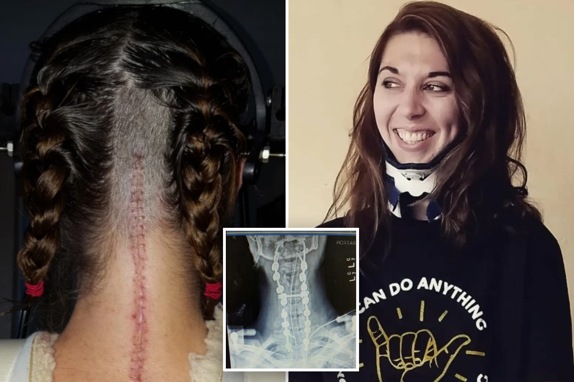 Decapitated woman’s head reattached after freak gym class accident: ‘Horror show’