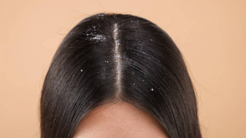 Este es el remedio natural que tenés que usar para eliminar la caspa y ...