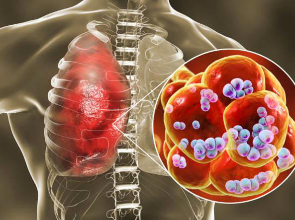 Cosa sono polmoniti e altre malattie da pneumococco, chi rischia di più ...