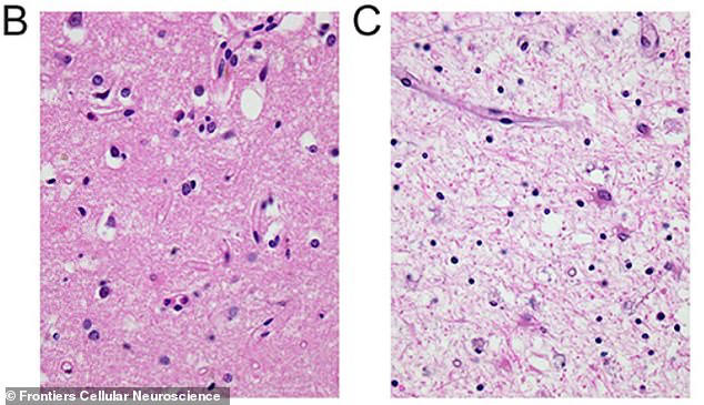 Doctors sound alarm as mystery brain disease spreads in US