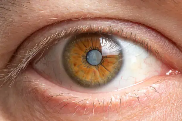 Doctors call glaucoma the ‘silent thief of sight’: Here's how to stop ...