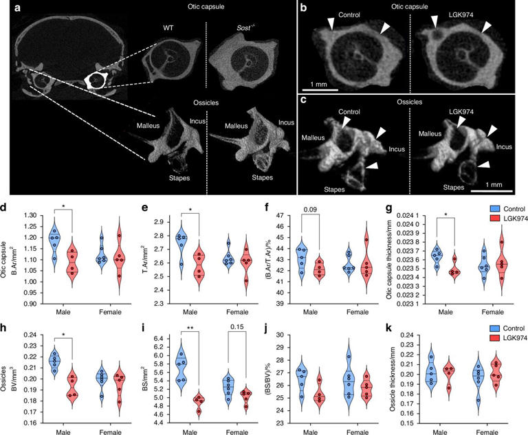 Porcupine inhibition represents a promising treatment for sclerosteosis ...