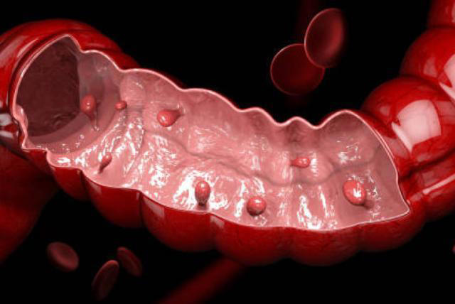 El síntoma que quizá no sabía que significa pólipos en el colon