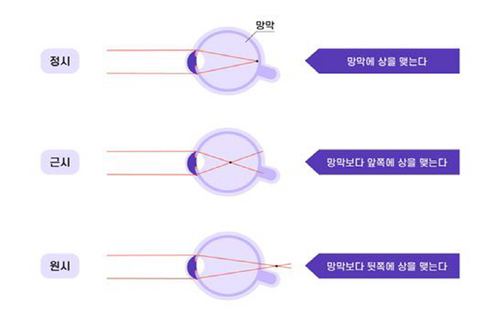 SmilePro Successfully Restored Primitive Orthodontics Eyesight...Onnuri ...