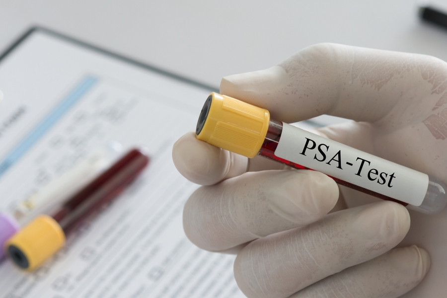 Why PSA Levels Increase After Prostate Cancer Treatment
