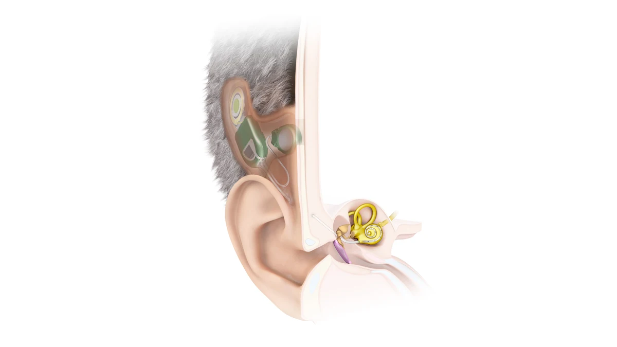 El nuevo dispositivo coclear "invisible" que se implanta íntegro