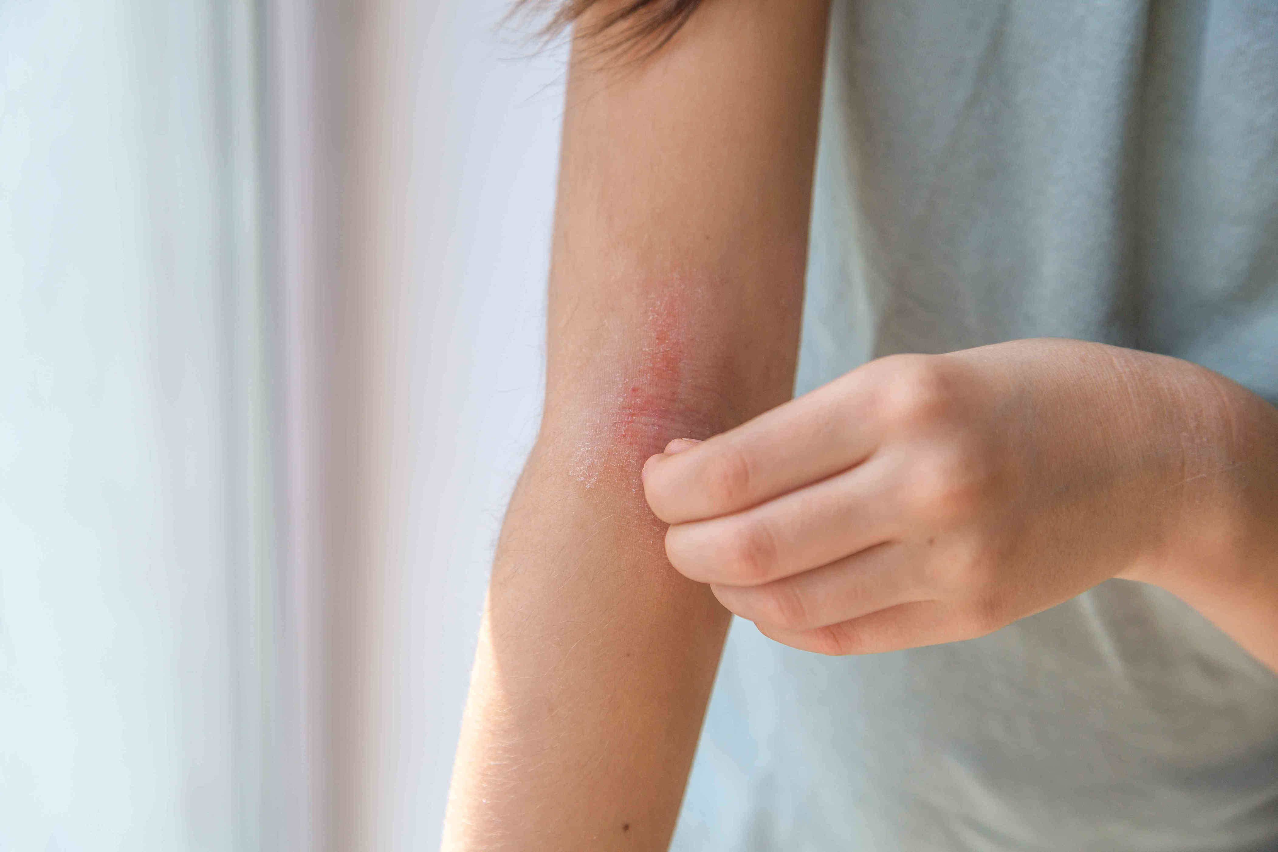 Why Treating Atopic Dermatitis Matters: Know the Risks