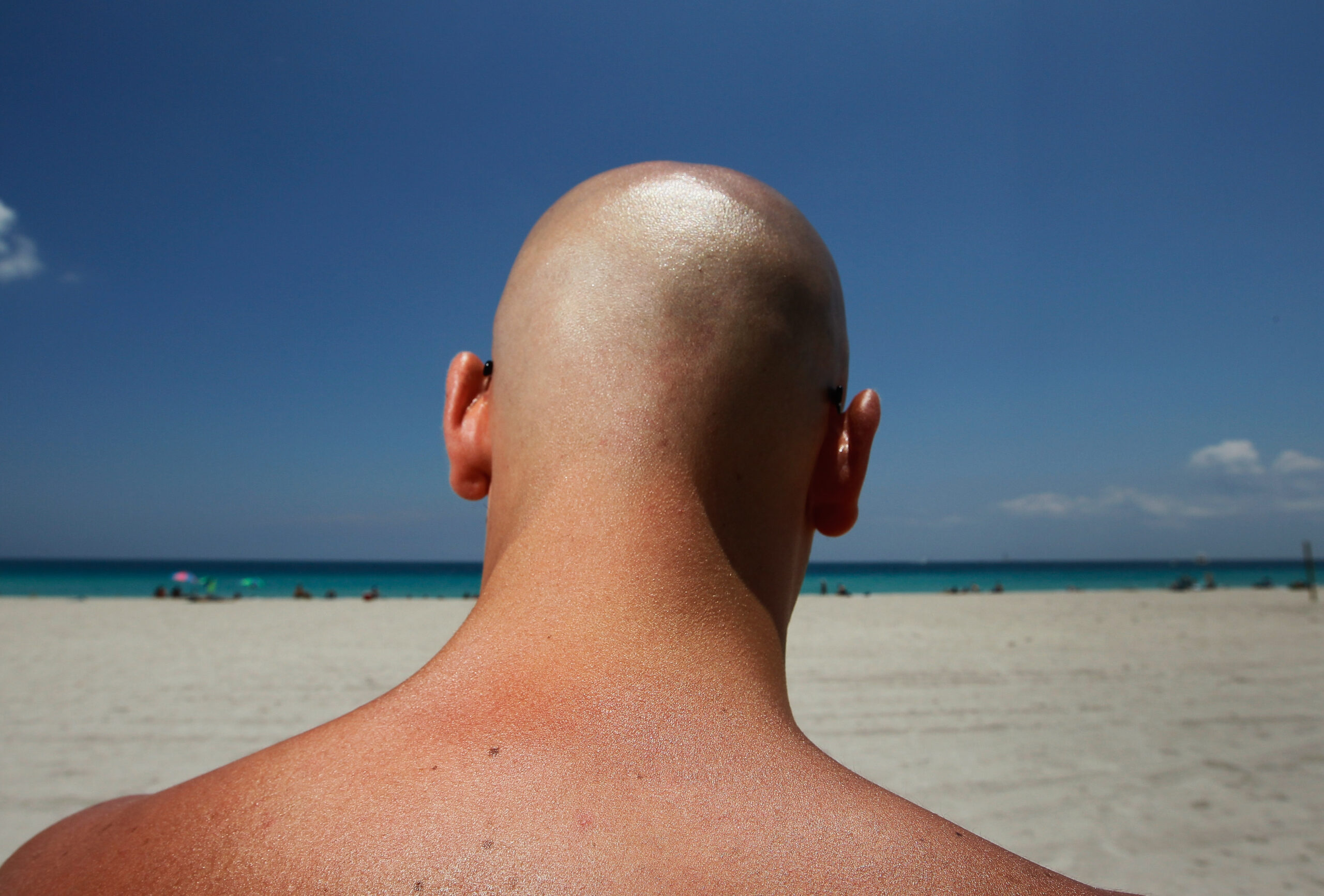 What’s the difference between freckles, sunspots and moles?