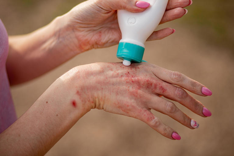 How to spot, treat and prevent scabies, according to the experts