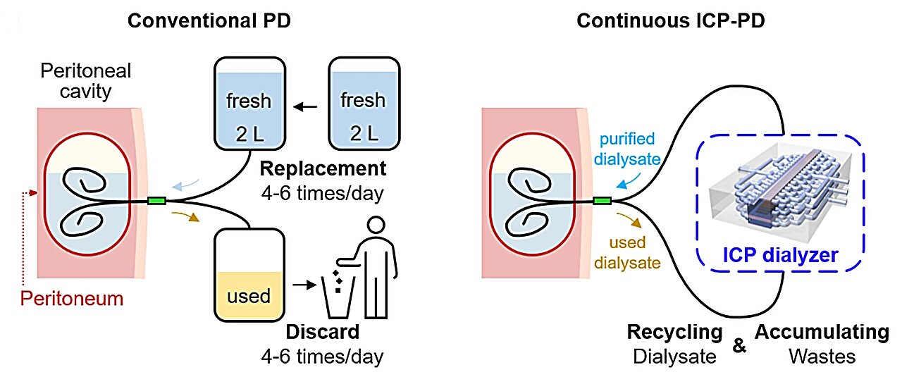 Dialysis device that uses nanoelectrokinetic technology could be used ...