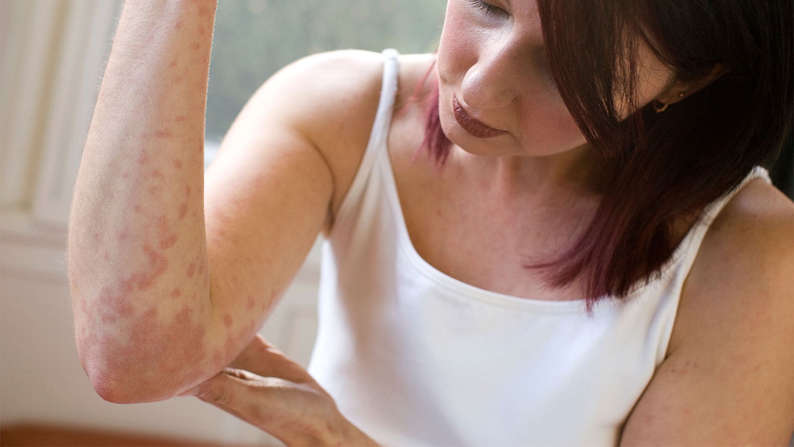 Study: Treat Adult-Onset Still's Disease With Biologics