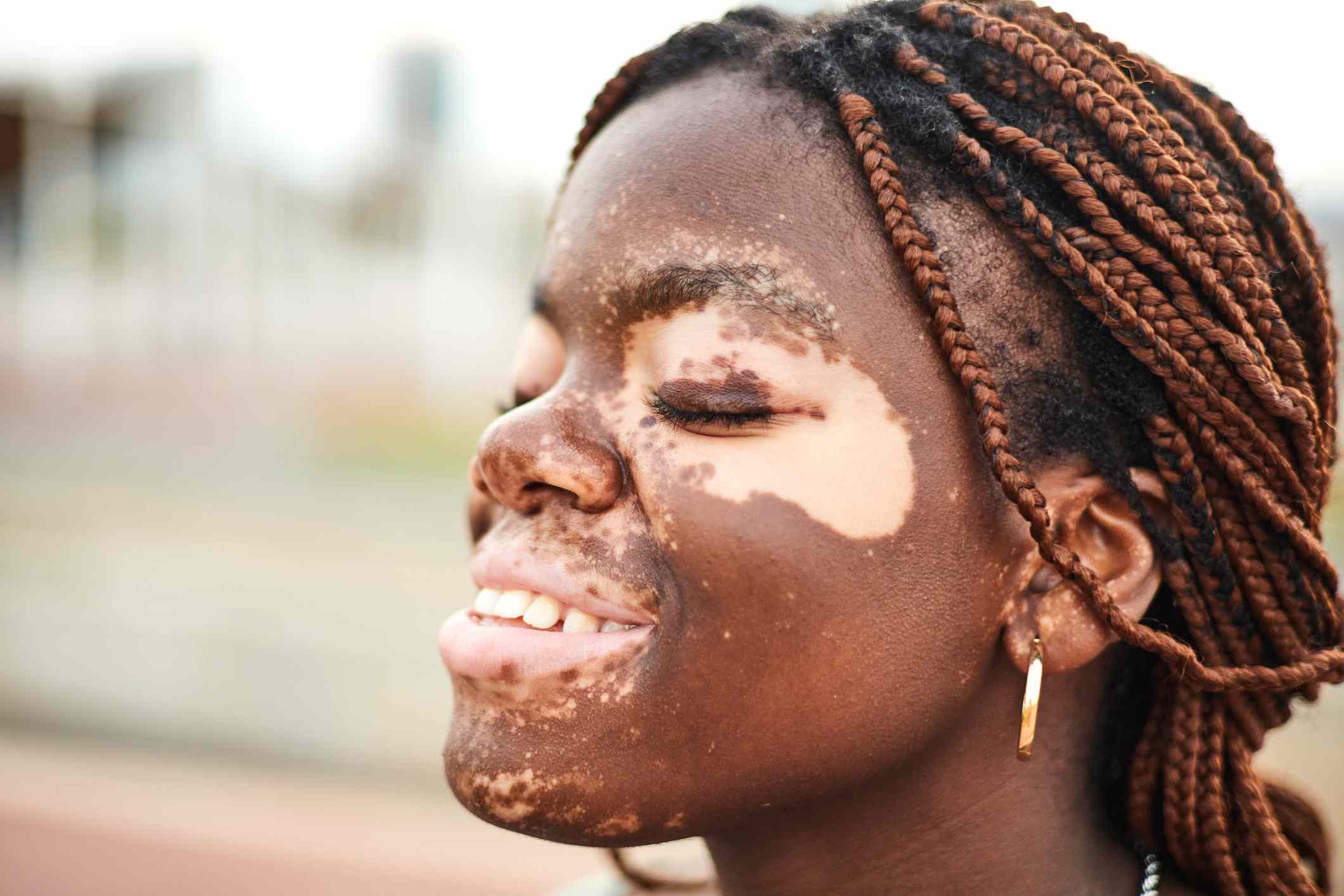 What To Know About Hypopigmentation