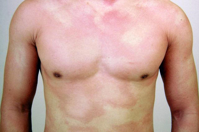 7 Drugs That Can Cause a Rash (and How to Identify a Skin Reaction)
