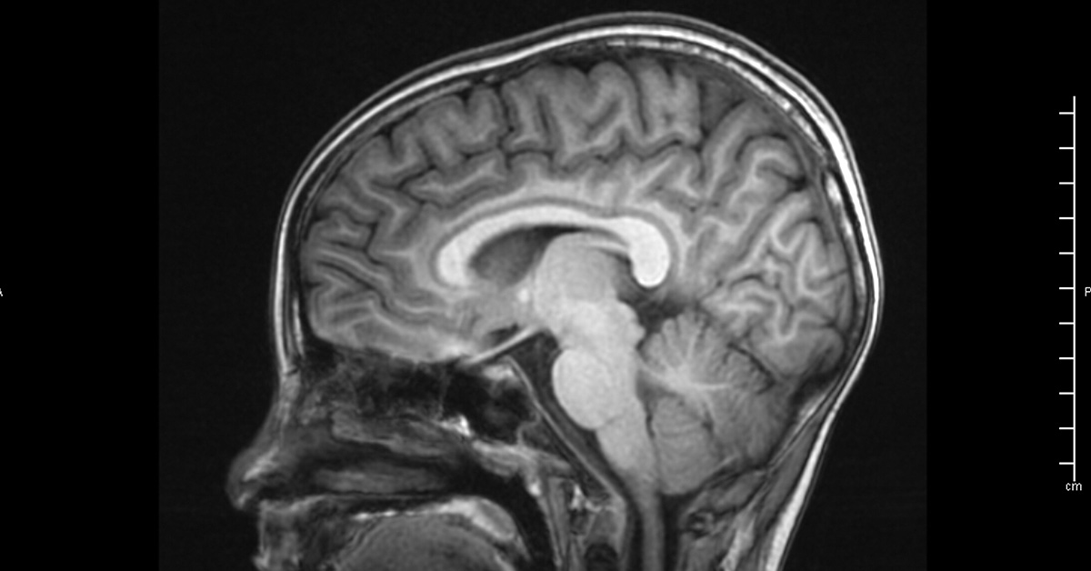 Researchers define new subtypes of common brain disorder