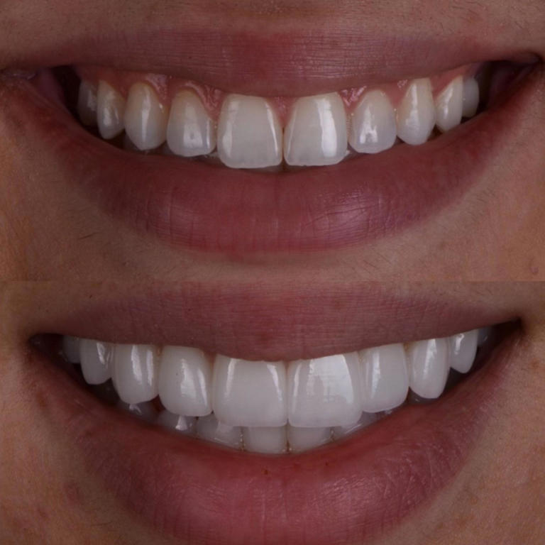 In an era of quiet glow-ups, no-prep veneers are the new 'it' cosmetic ...