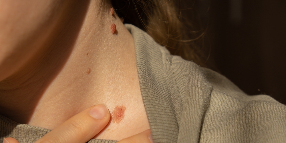 The science of skin spots: What’s harmless and what’s not