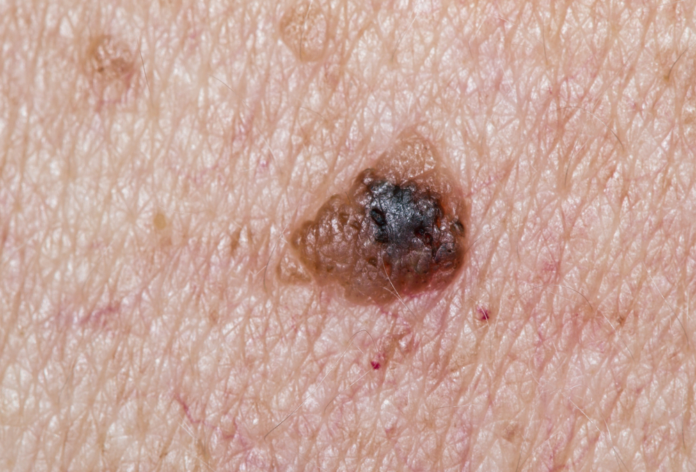 Early warning signs on your face that could signal dangerous cancer