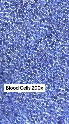 What Would Happen if You Received the Wrong Blood Type?