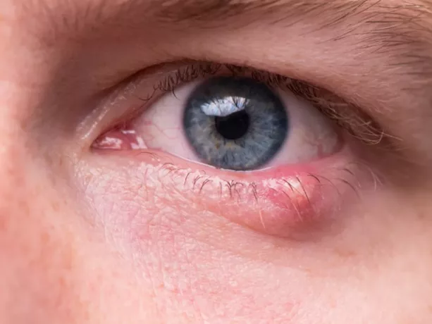 Penyakit Bintitan: Ini Dia Gejala dan Cara Penyembuhannya