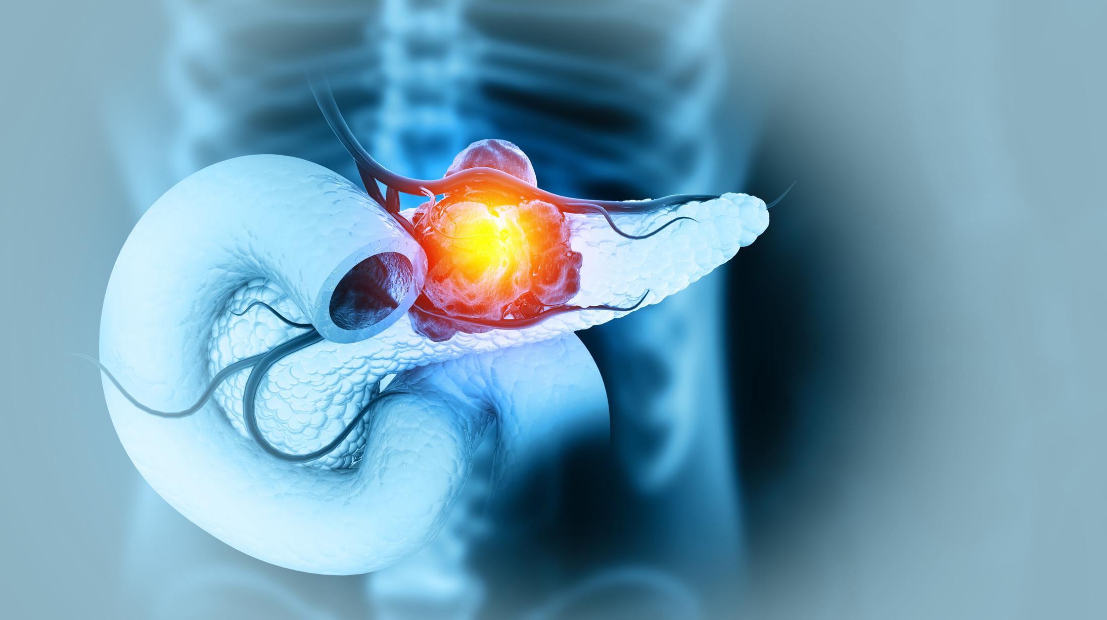 Tumore del pancreas: i motivi salvavita per rivolgersi a una Pancreas ...
