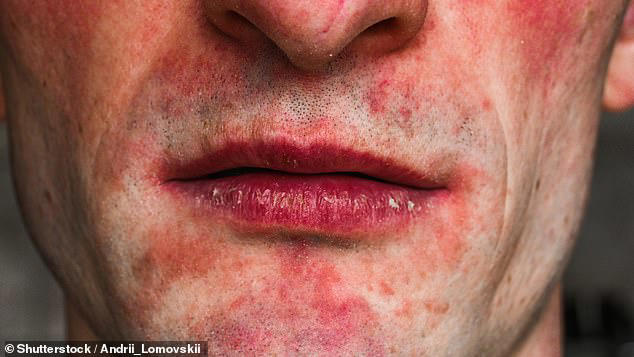 Common skin condition could be sign of deadly liver disease