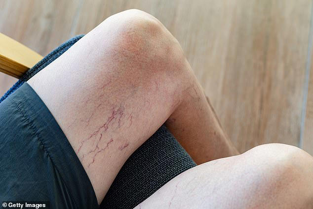 Common skin condition could be sign of deadly liver disease