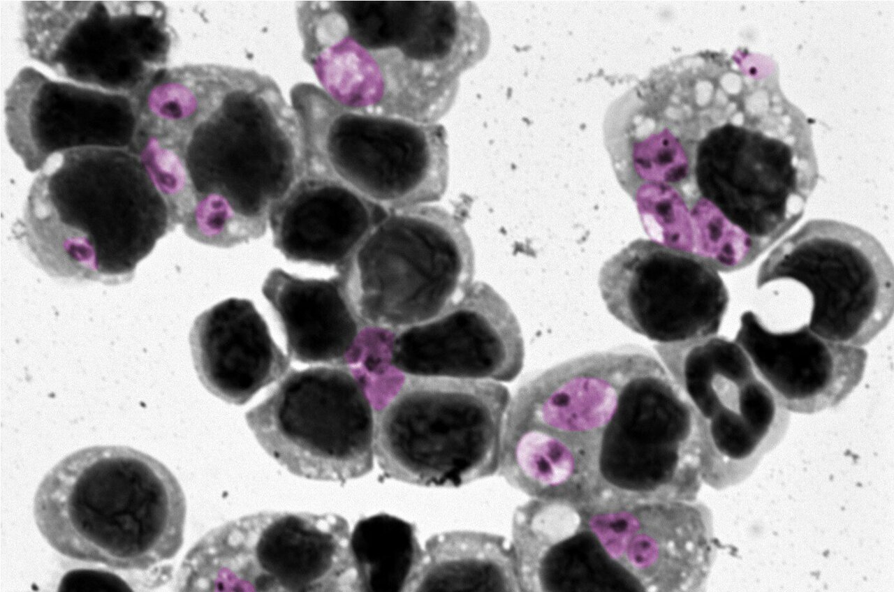 Biomarkers help predict treatment success for parasitic skin disease