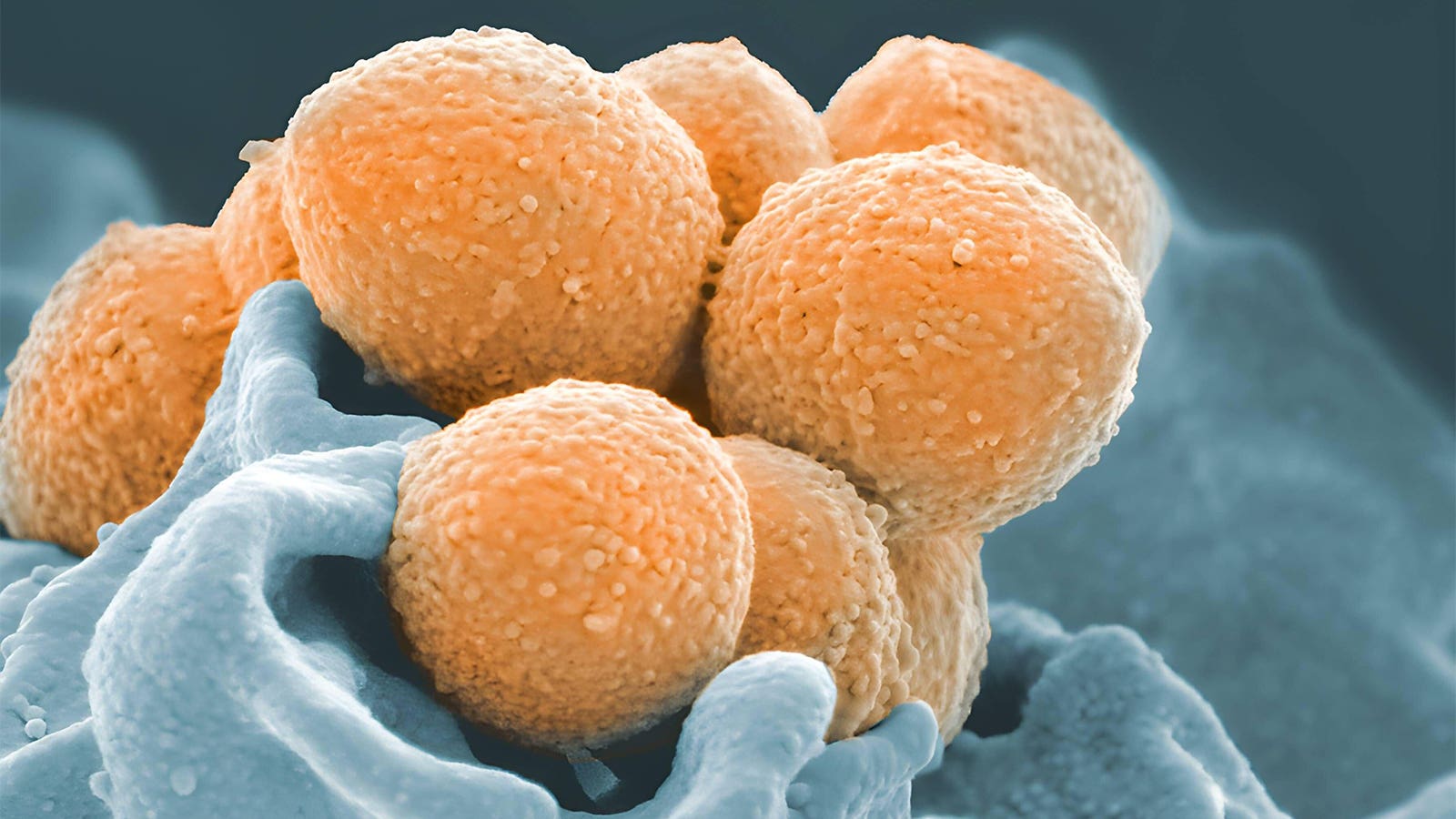 U.S. Cases of Invasive Group A Strep More Than Doubled Over 9-Year Stretch