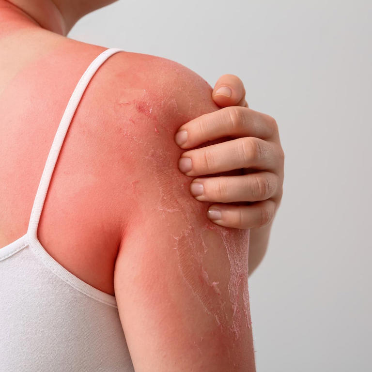 Natural Sunburn Relief: 15 Home Remedies That Actually Work