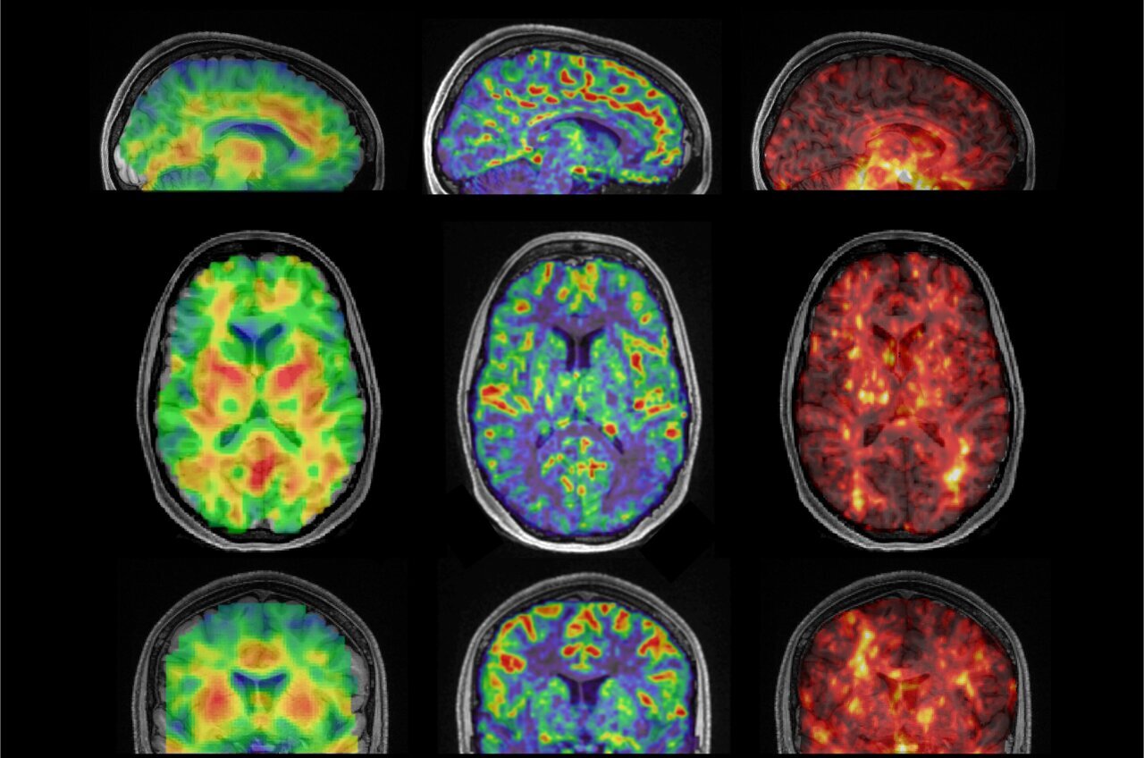 Exploring the link between blood flow, brain stiffness and Alzheimer's risk