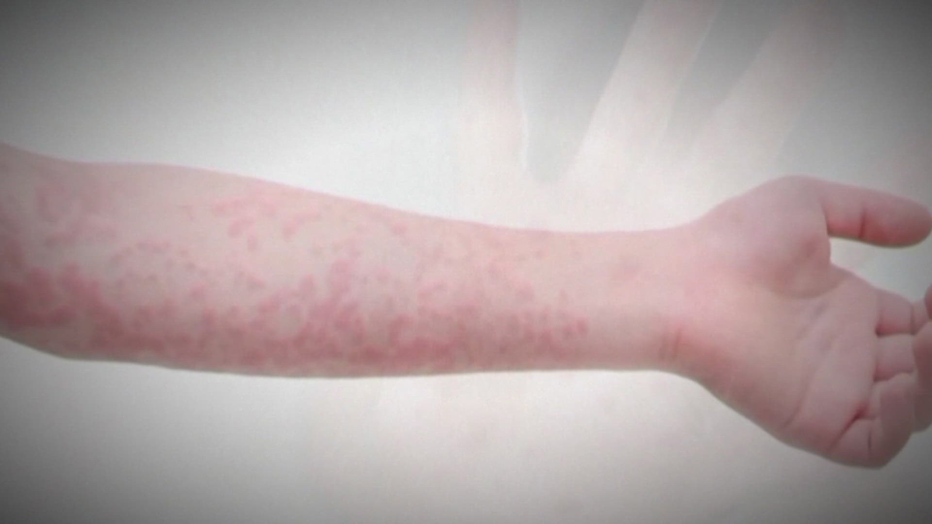 Eight-year-old girl becomes second Measles death in Texas