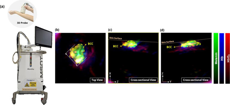 Scientists pioneer noninvasive 3D imaging to enhance skin cancer management