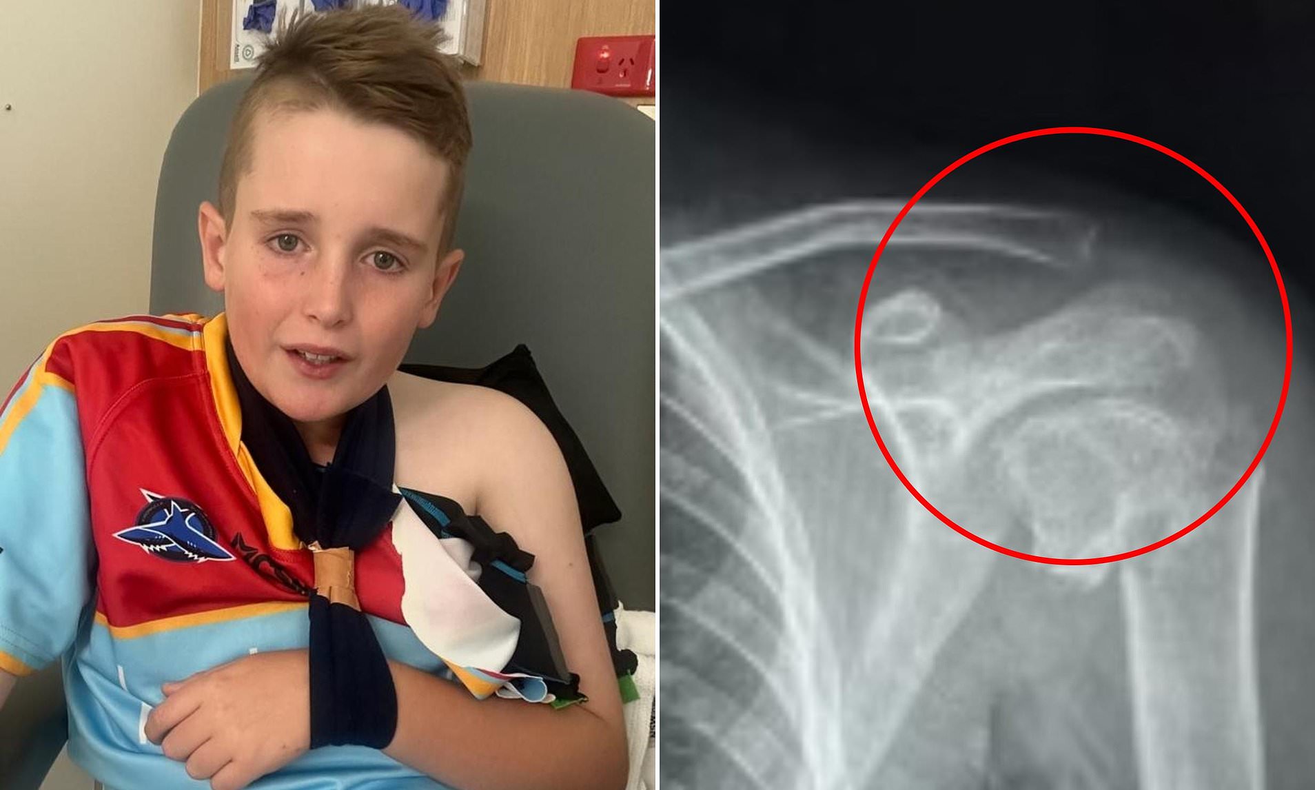 See the shocking moment boy, 12, has his shoulder shattered by ...